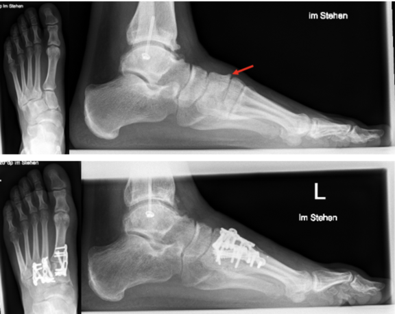 Mittelfußarthrose — Orthoprofis